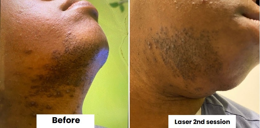 Laser Hair Removal - Elastic Wax & Laser Center